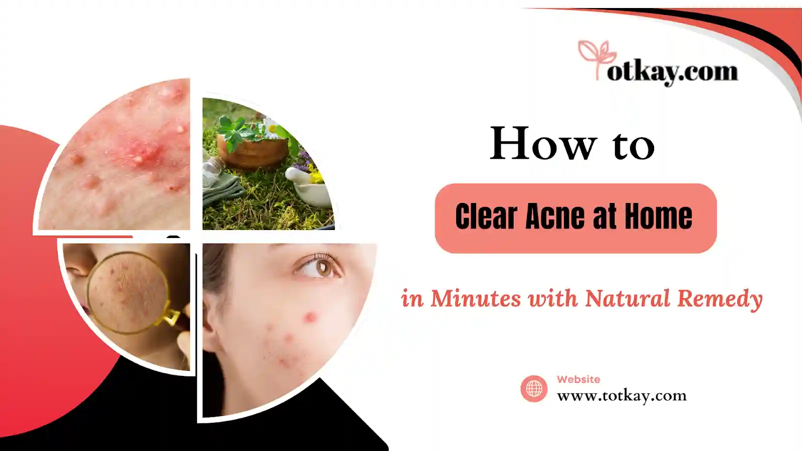 How to Clear Acne at Home in Minutes with Natural Remedy - Totkay