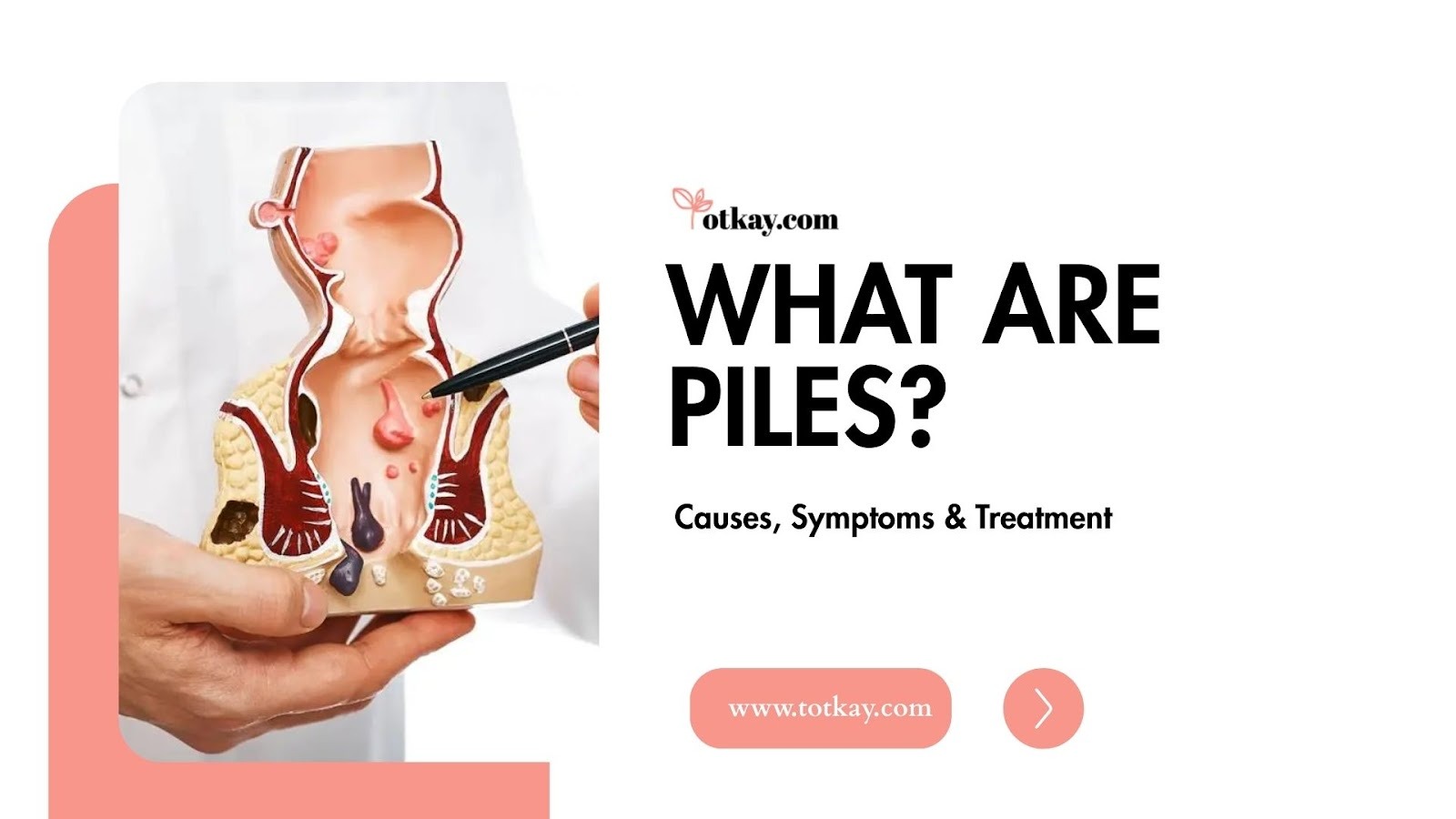 What Are Piles? Causes, Symptoms & Treatment - Totkay