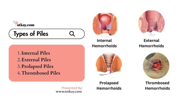 What Are Piles? Causes, Symptoms & Treatment - Totkay